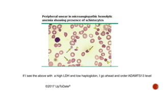 MAHA/TTP/DIC/HUS/aHUS | PPTX