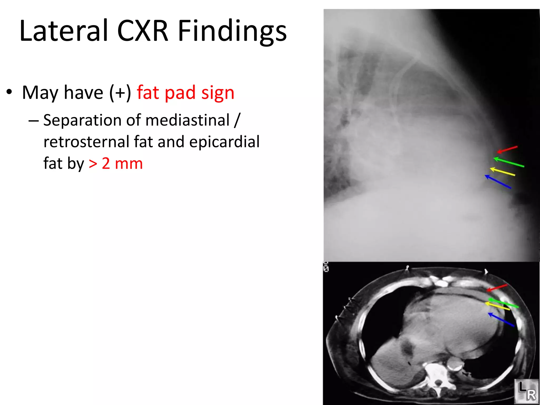 pericardial effusion | PPTX