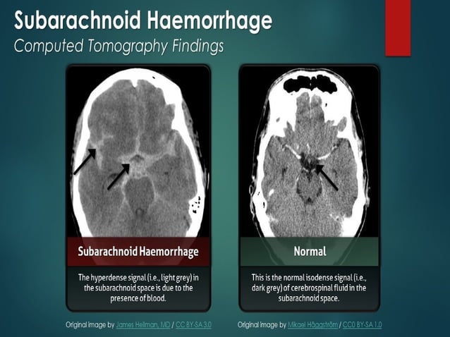Subarachnoid Haemorrhage | PPT