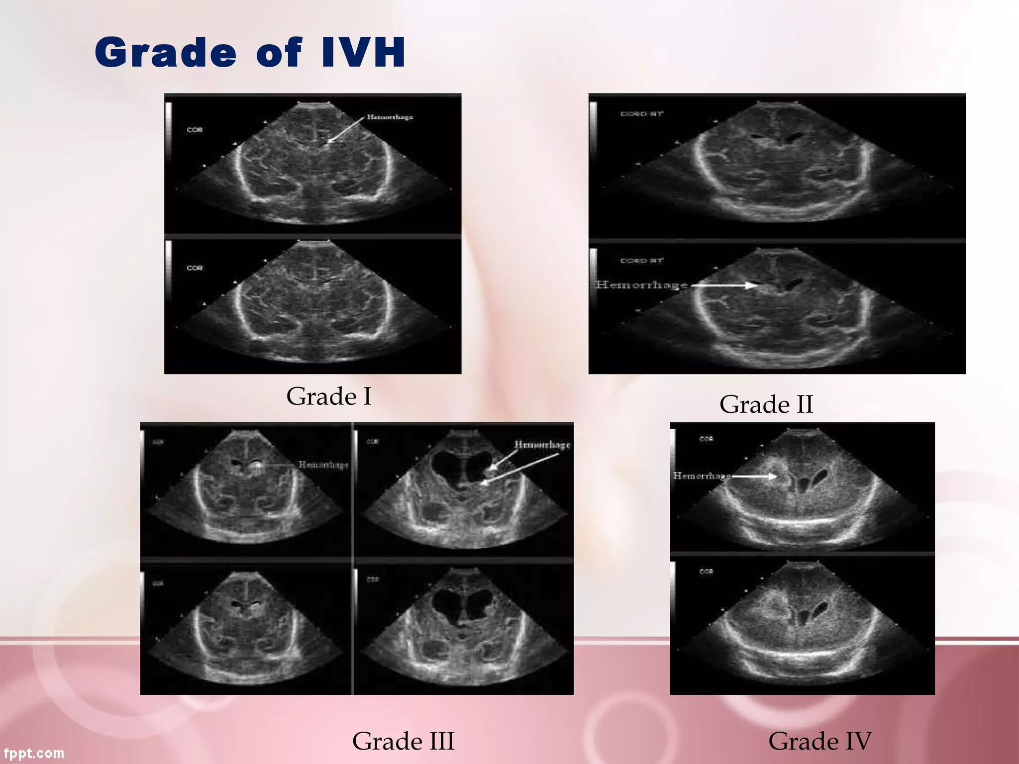 Interventricular hemorrhage in neonate | PPT