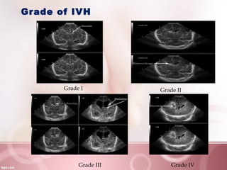 Interventricular hemorrhage in neonate | PPT