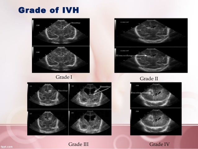 Interventricular hemorrhage in neonate