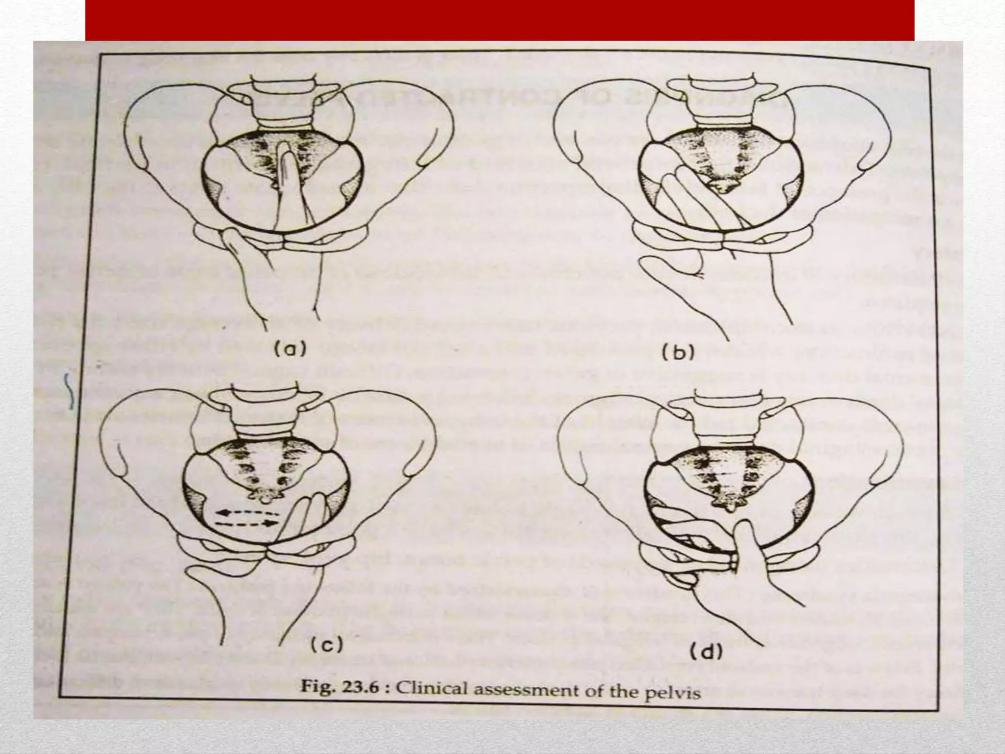 Cephalopelvic disproportion (CPD) & Contracted pelvis | PPTX