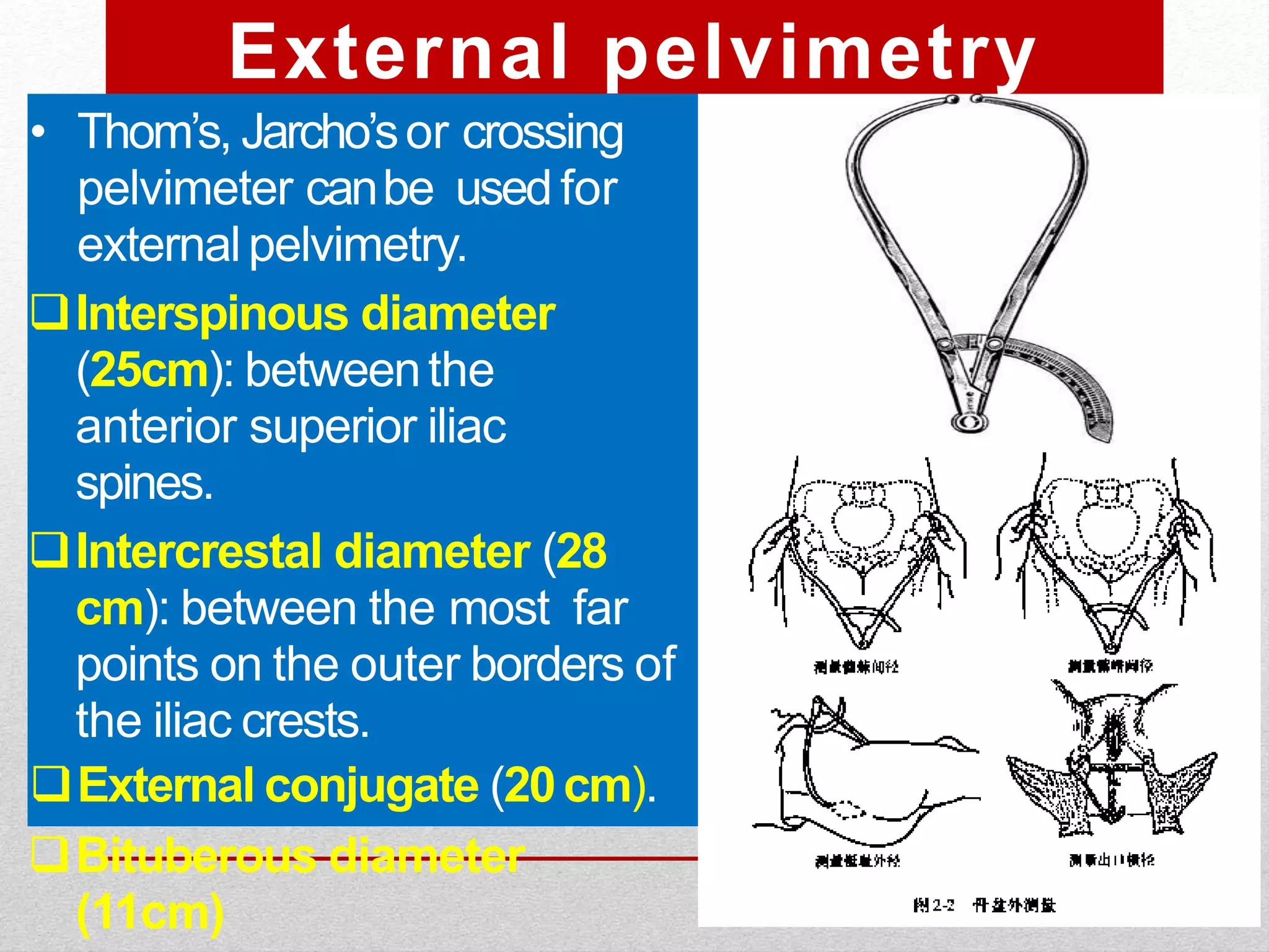 Cephalopelvic disproportion (CPD) & Contracted pelvis | PPTX