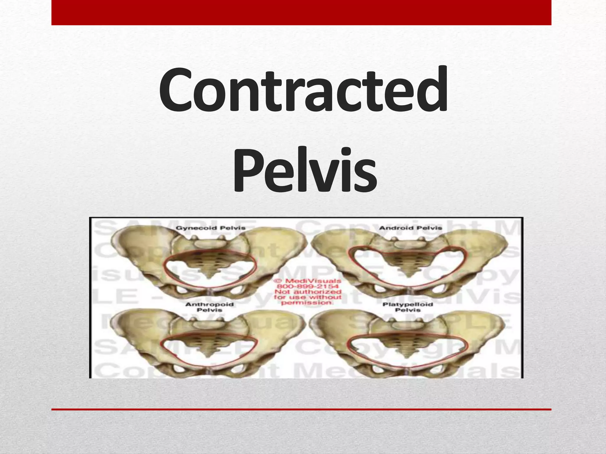 Cephalopelvic disproportion (CPD) & Contracted pelvis | PPTX