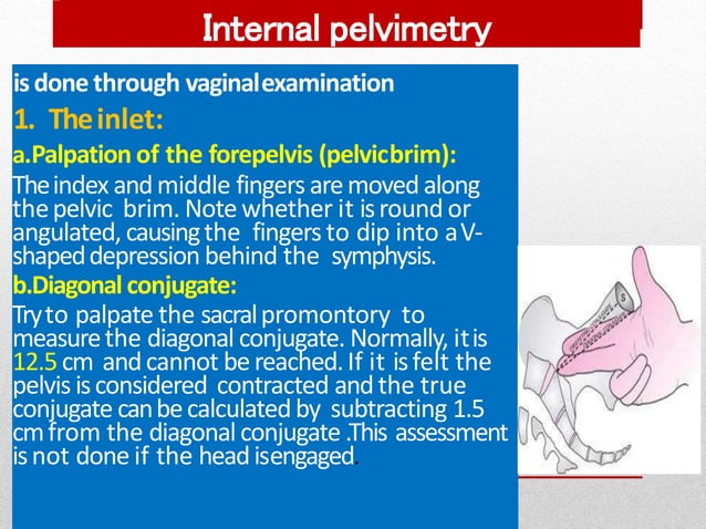 Cephalopelvic disproportion (CPD) & Contracted pelvis | PPTX ...