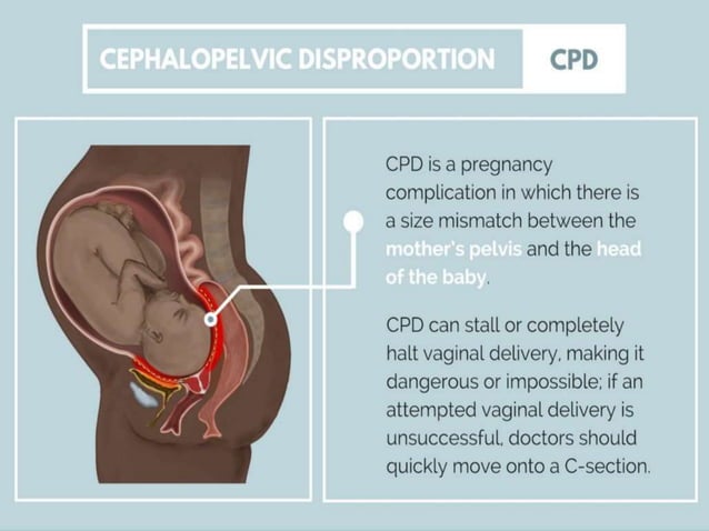 Cephalopelvic disproportion (CPD) & Contracted pelvis | PPTX ...