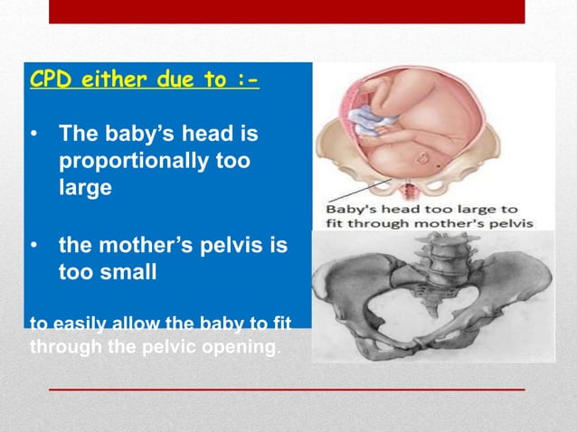 Cephalopelvic disproportion (CPD) & Contracted pelvis | PPTX ...