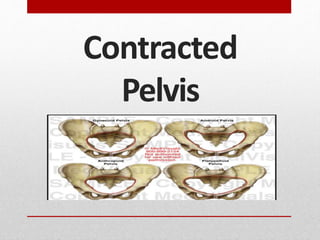 Cephalopelvic disproportion (CPD) & Contracted pelvis | PPTX