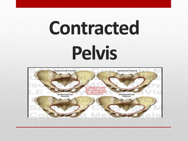 Cephalopelvic disproportion (CPD) & Contracted pelvis | PPTX ...