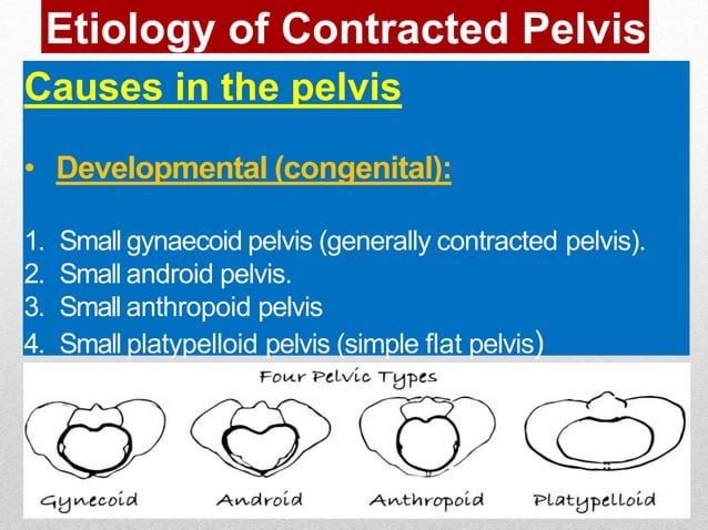 Cephalopelvic disproportion (CPD) & Contracted pelvis | PPTX ...