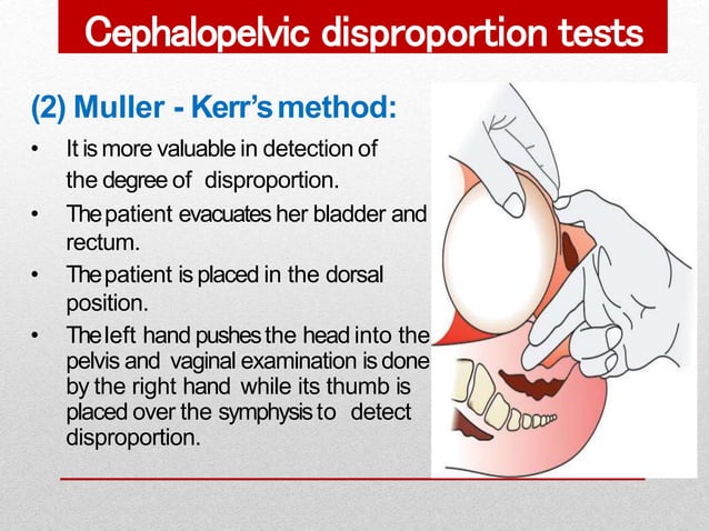 Cephalopelvic disproportion (CPD) & Contracted pelvis