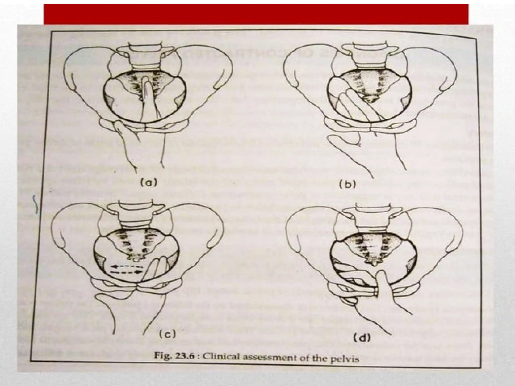 Cephalo pelvic disproportion obstetrics and gynaecological nursing | PPTX