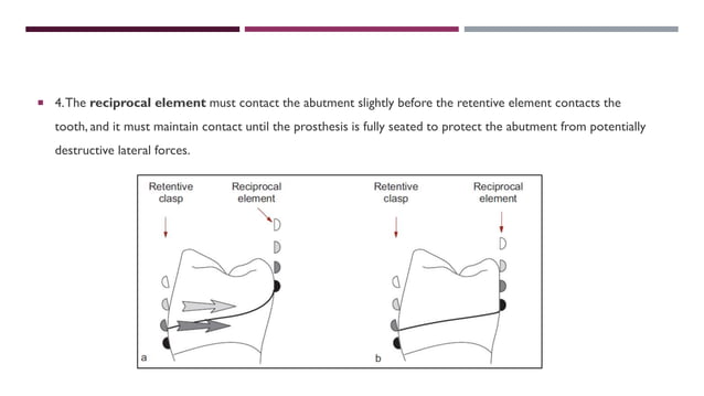 INTRODUCTION TO DIRECT RETAINERS IN CPD | PDF | Dental Health ...