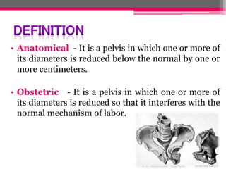 Cpd and contracted pelvis | PPTX