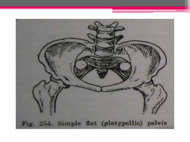 Cpd and contracted pelvis | PPTX | Pregnancy | Reproductive Health