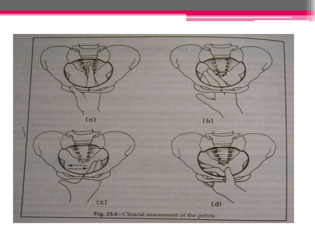 Cpd and contracted pelvis | PPTX | Pregnancy | Reproductive Health