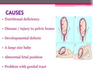 Cephalopelvic Disproportion Pathophysiology
