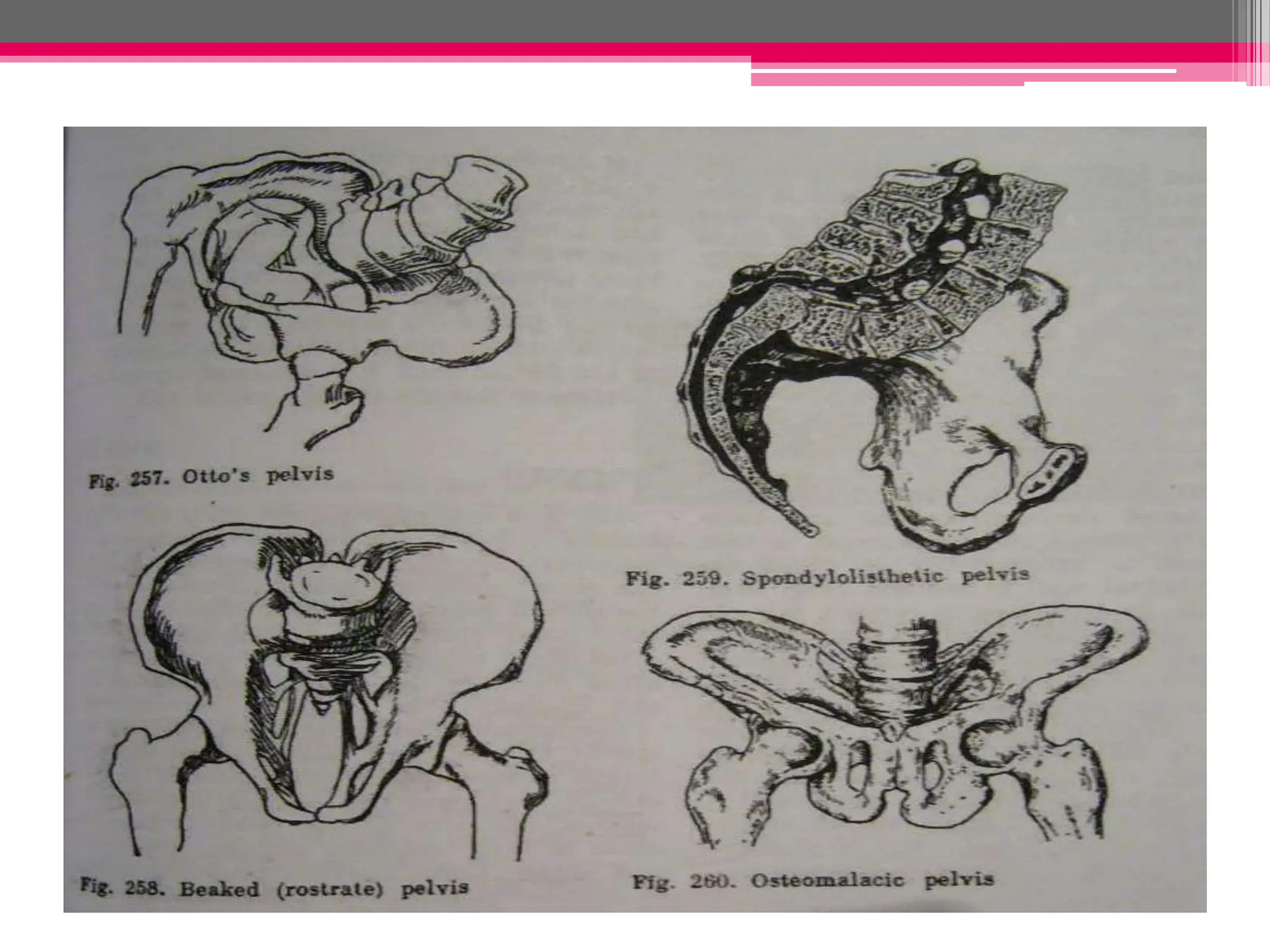 contractedpelvis & CEPHALOPELVIC DISPROPOTION | PPTX