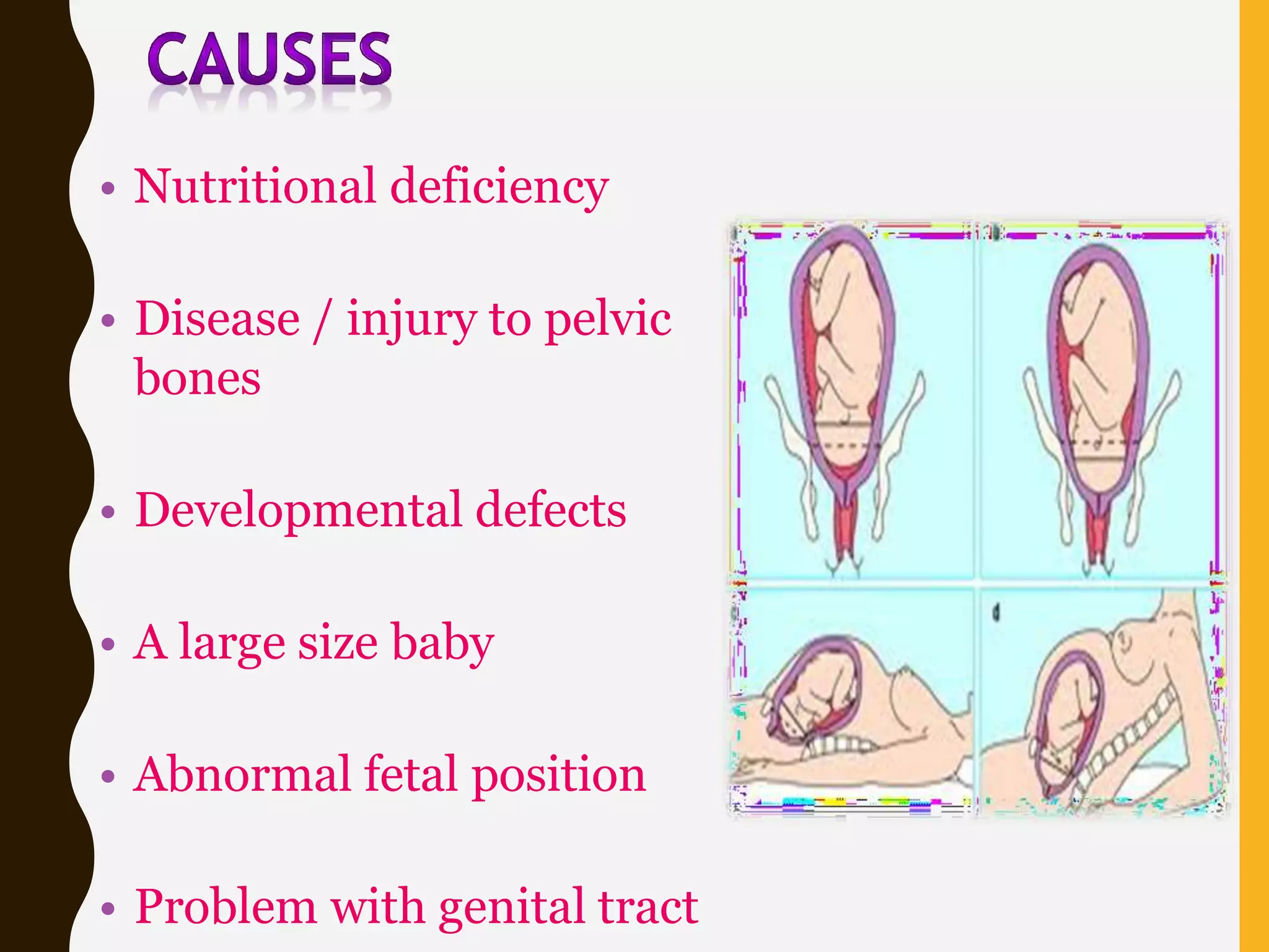 Cpd & contracted pelvis | PPTX