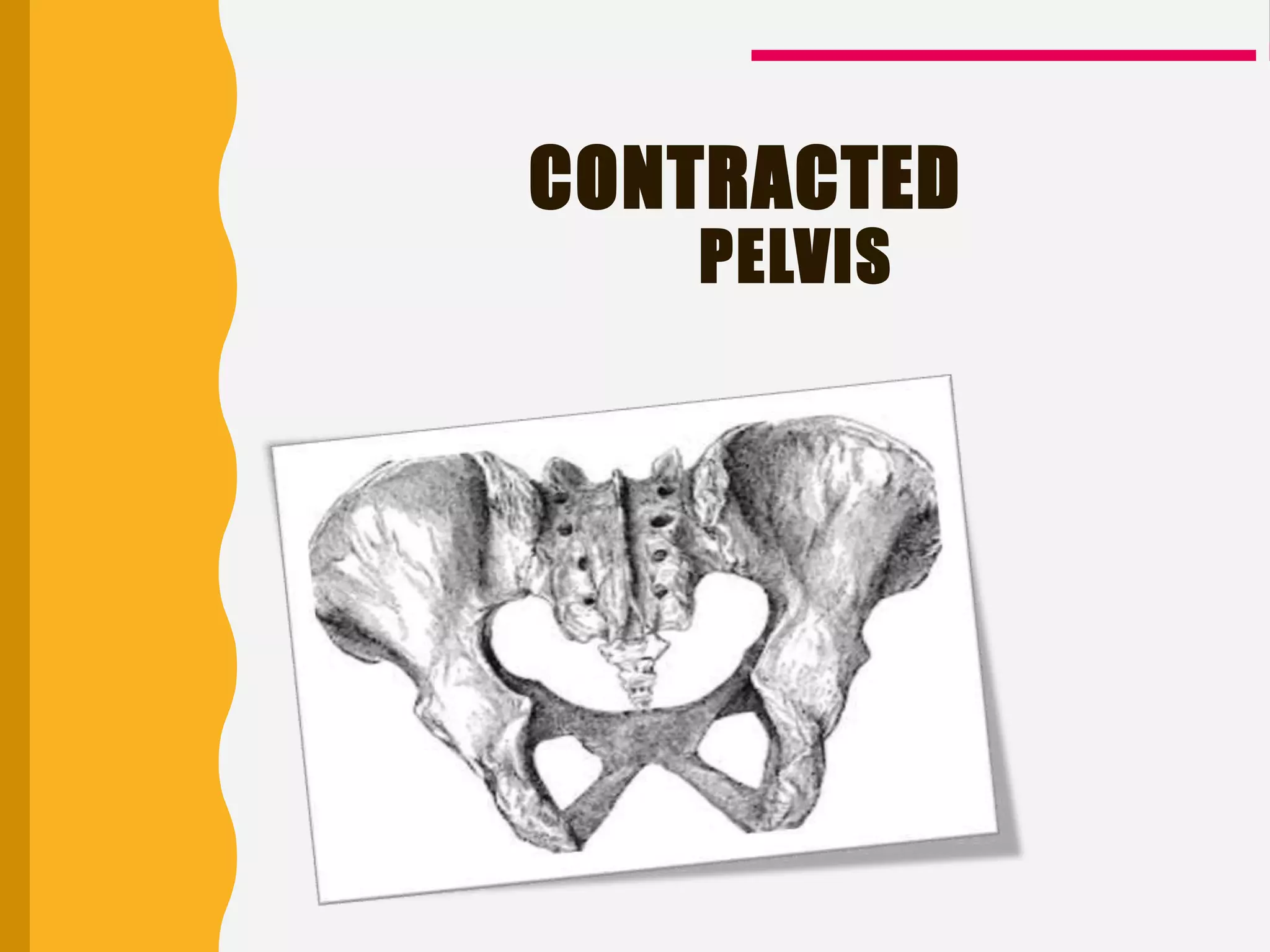 Cpd & contracted pelvis | PPTX