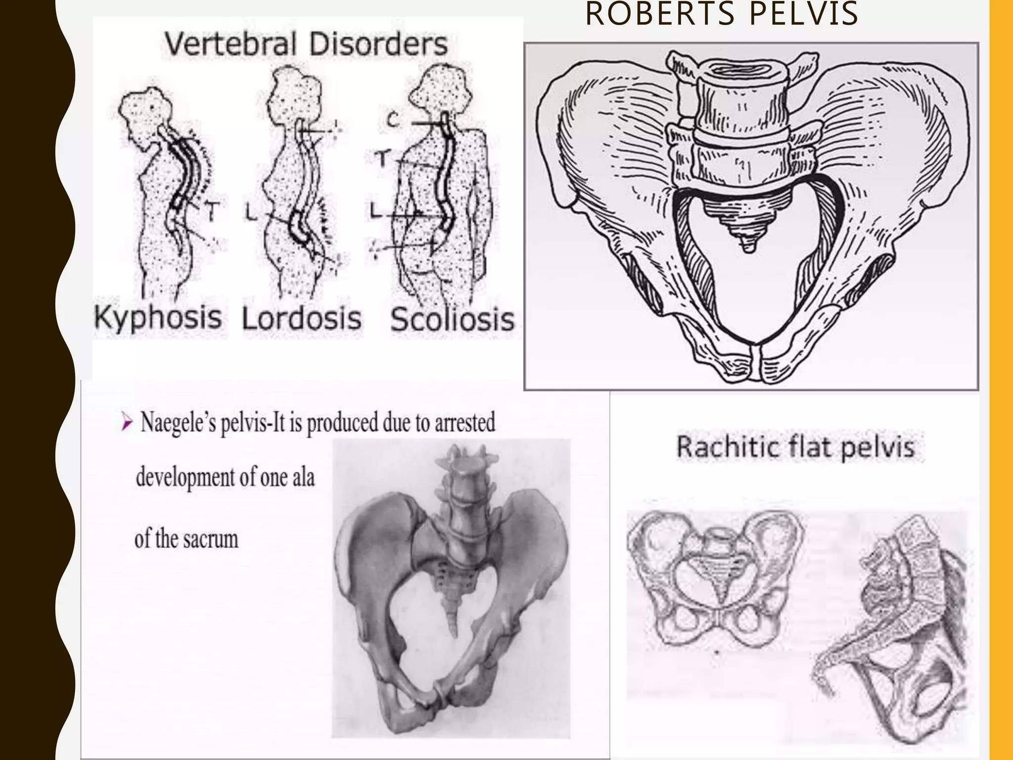 Cpd & contracted pelvis | PPTX