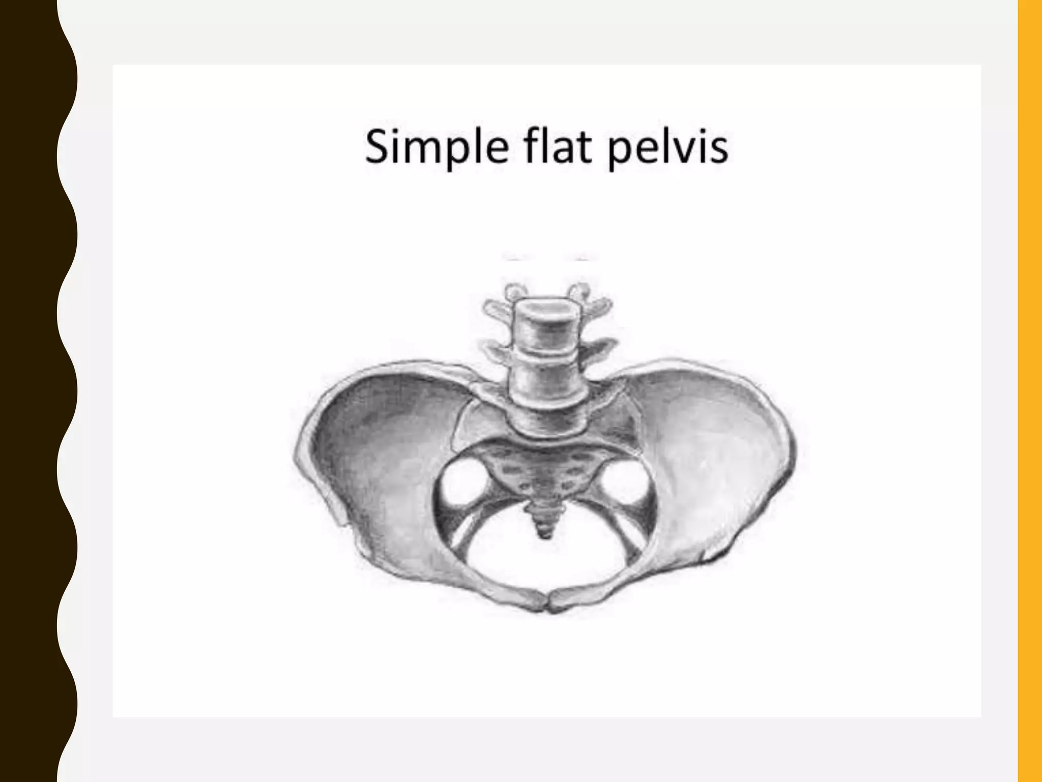 Cpd & contracted pelvis | PPTX