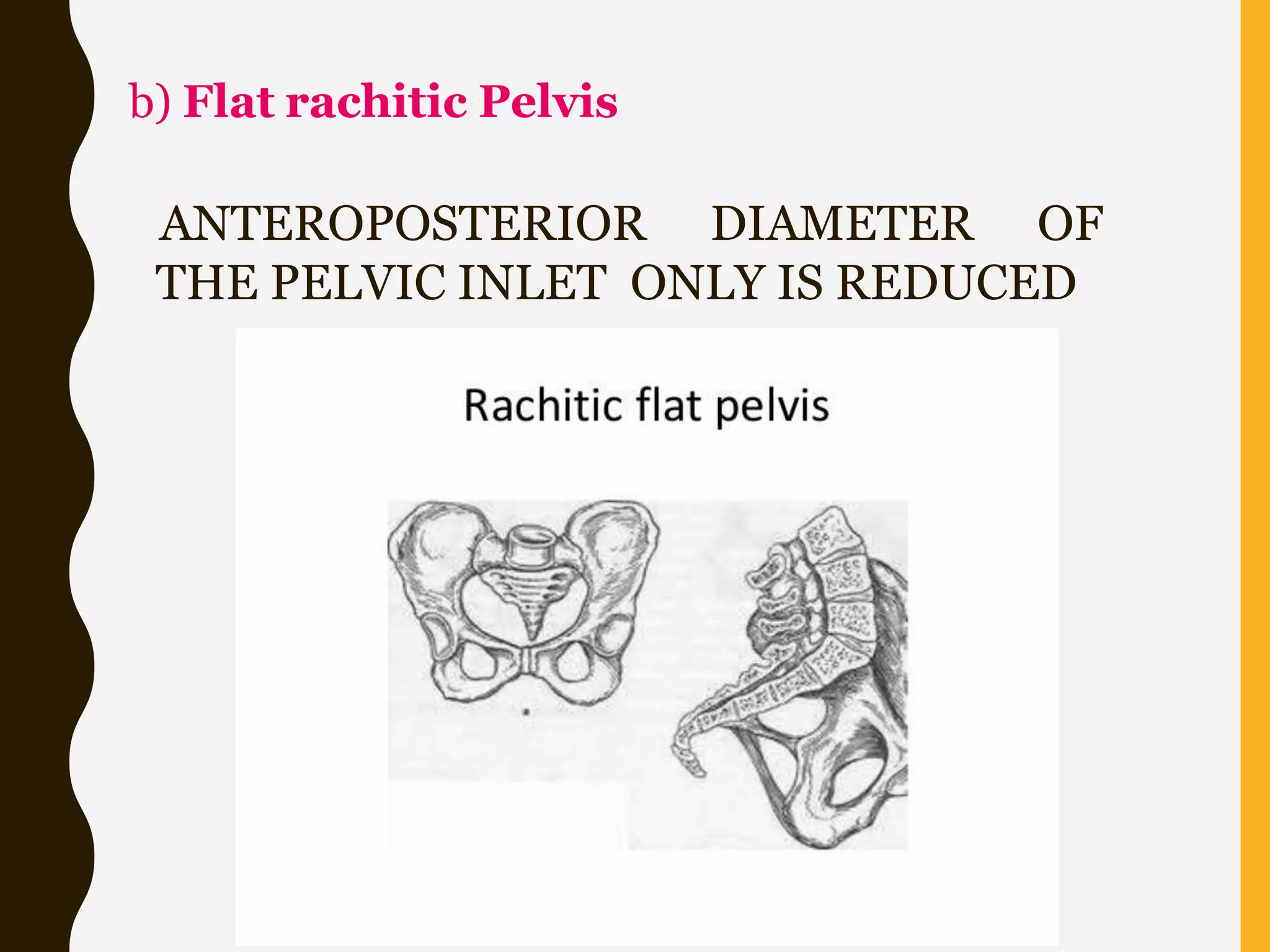 Cpd & contracted pelvis | PPTX