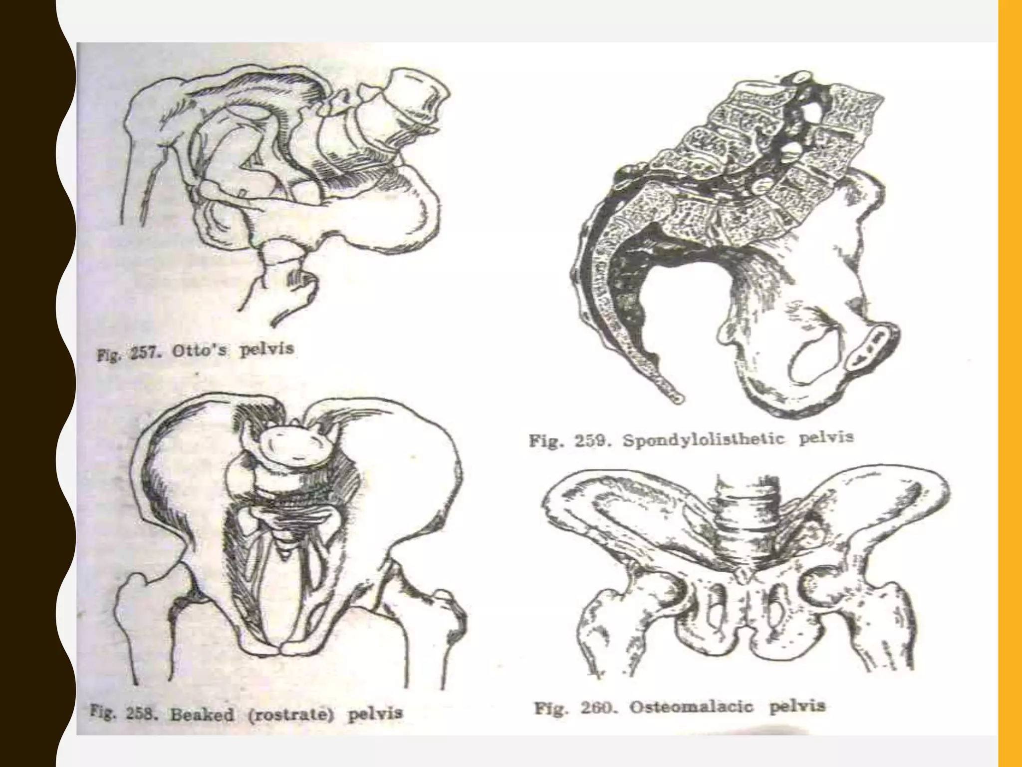 Cpd & contracted pelvis | PPTX