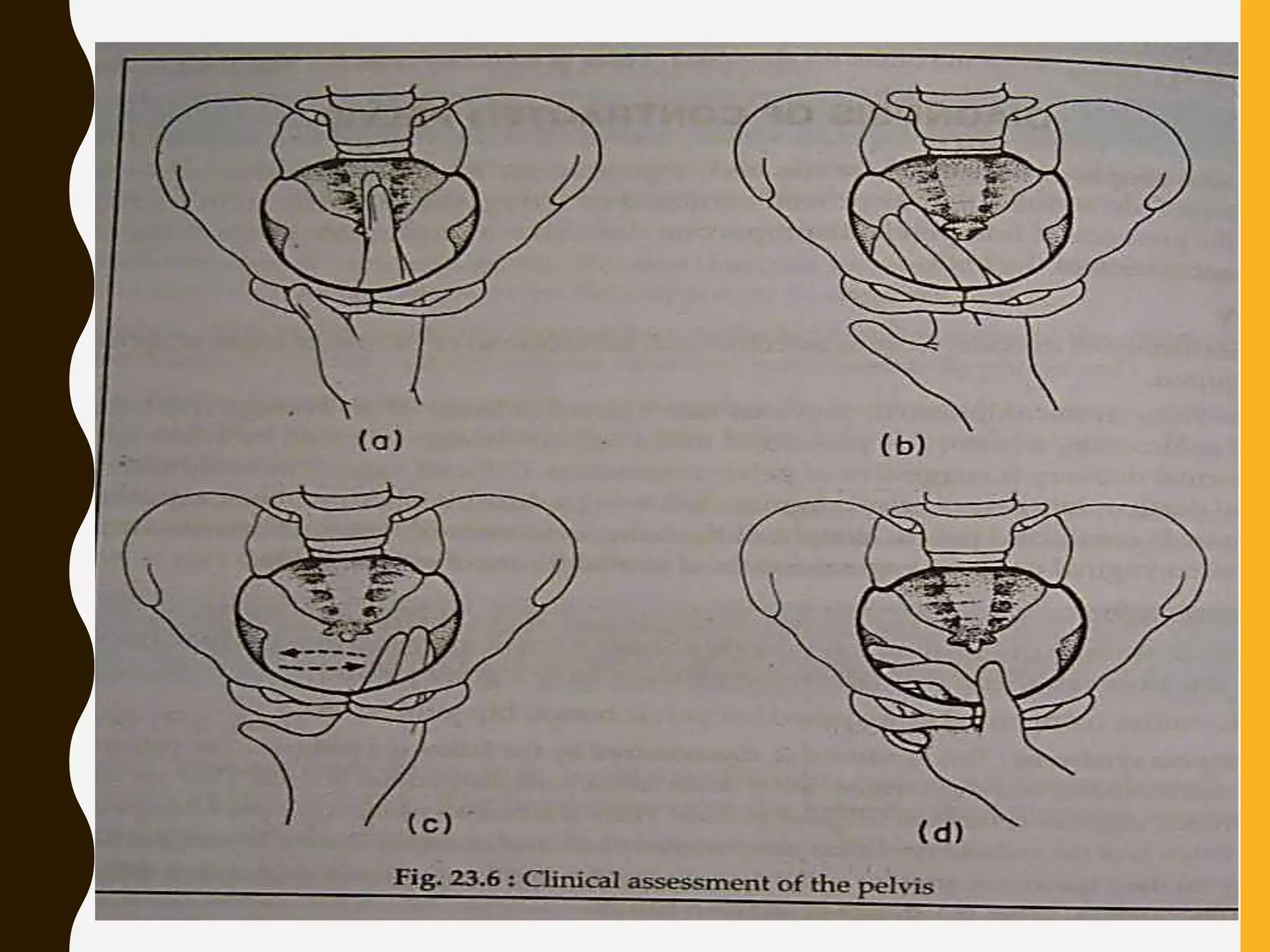 Cpd & contracted pelvis | PPTX