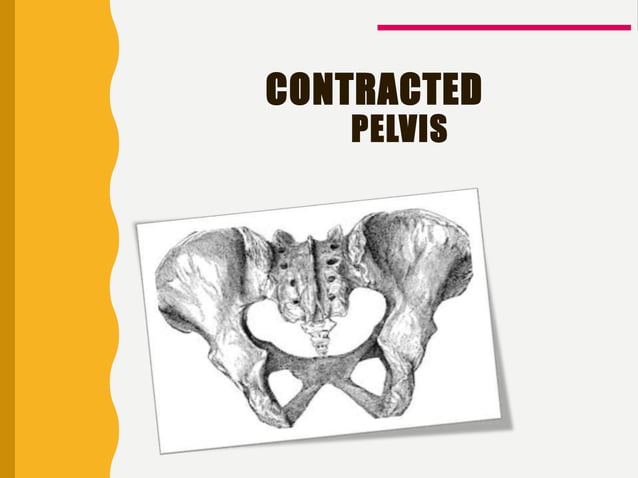 Cpd & contracted pelvis | PPTX | Pregnancy | Reproductive Health