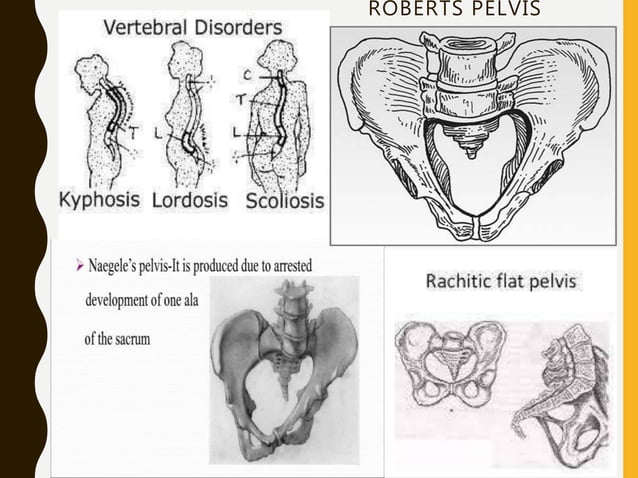 Cpd & contracted pelvis | PPTX | Pregnancy | Reproductive Health