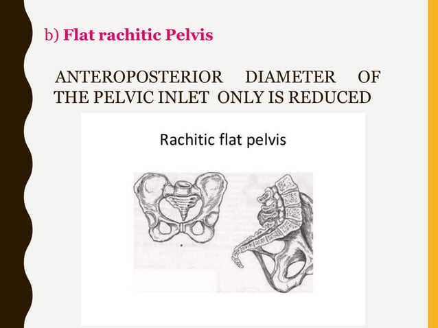 Cpd & contracted pelvis | PPTX | Pregnancy | Reproductive Health