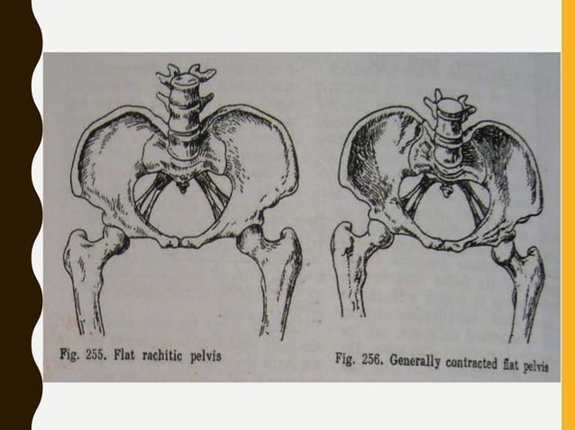 Cpd & contracted pelvis | PPTX | Pregnancy | Reproductive Health