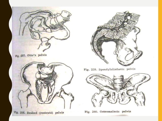 Cpd & contracted pelvis | PPTX | Pregnancy | Reproductive Health