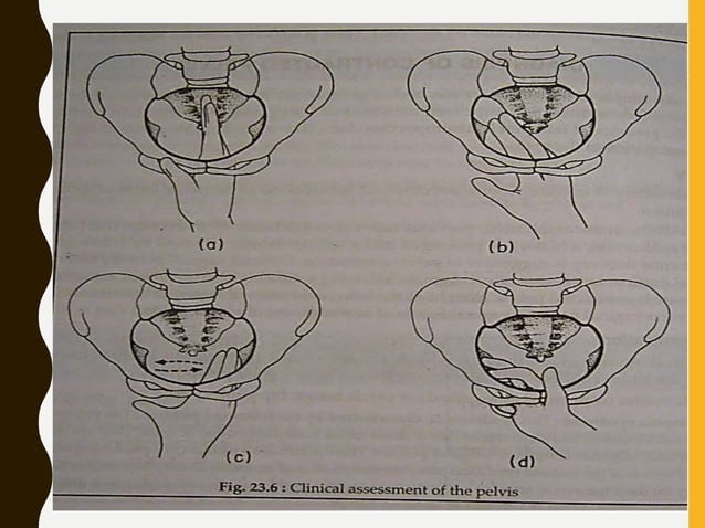 Cpd & contracted pelvis | PPTX | Pregnancy | Reproductive Health