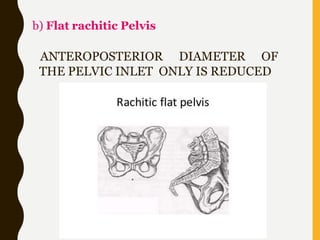 Rachitic Pelvis
