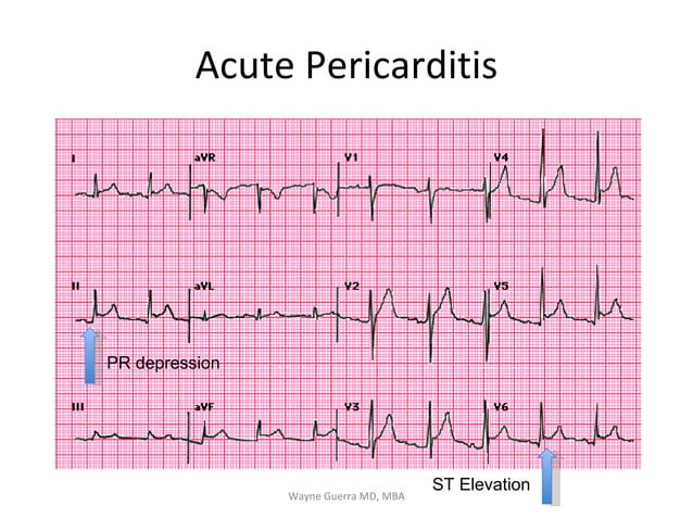 Chest Pain: EMS Review | PPT | Heart and Cardiovascular Diseases ...