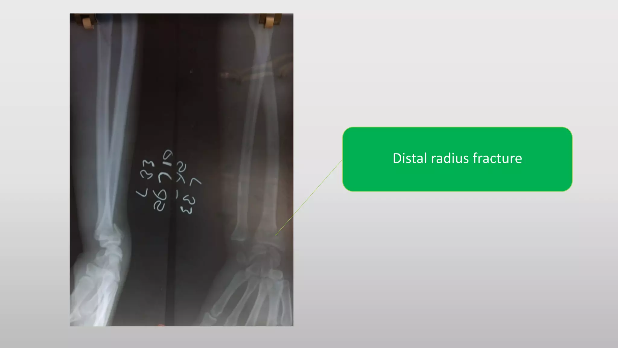 Case Presentation on Fracture & its Healing Process | PDF