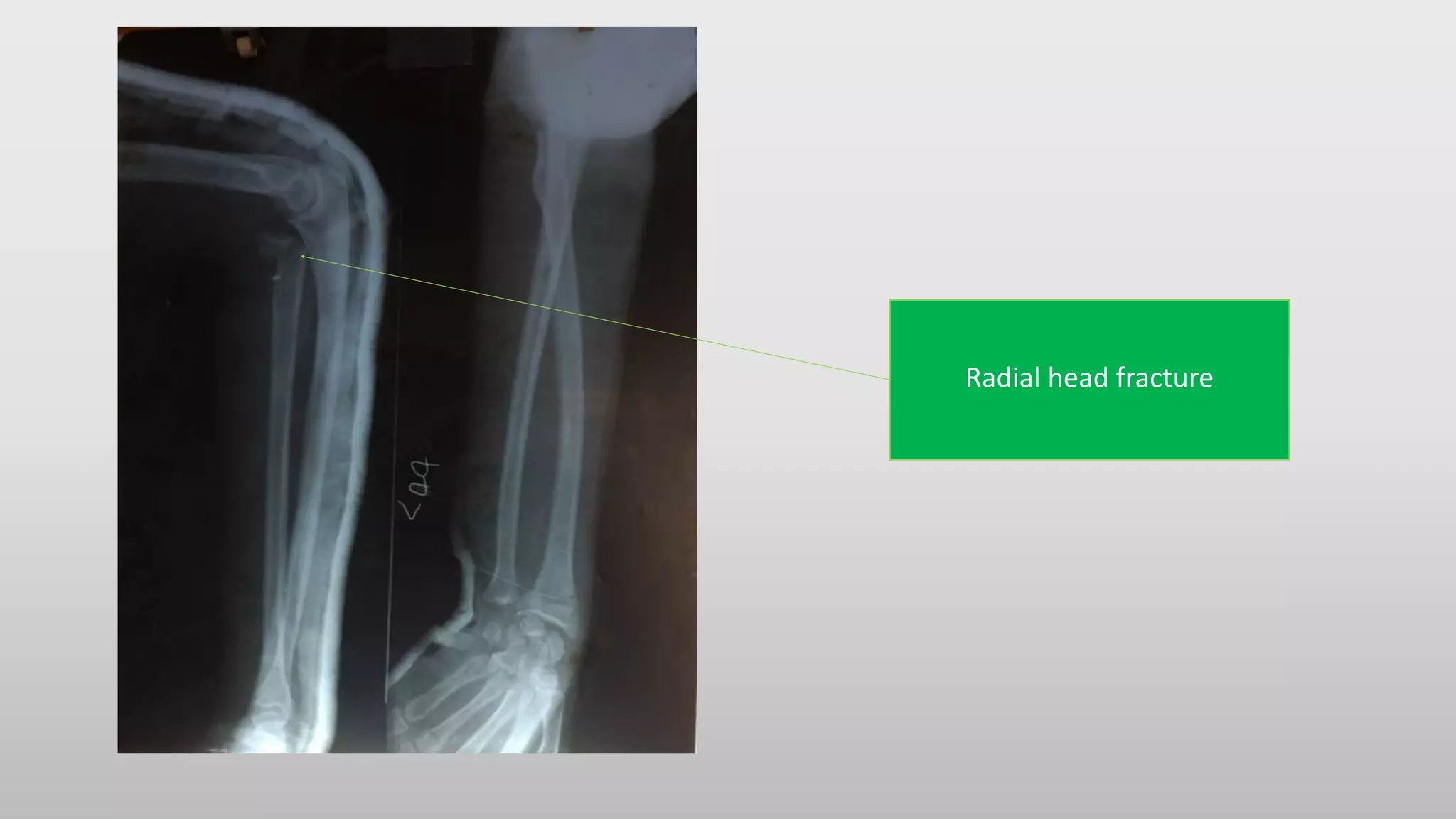 Case Presentation on Fracture & its Healing Process | PDF