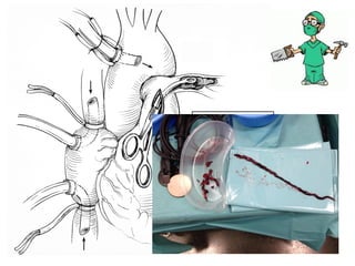 Kunne det være en lungeemboli? | PDF