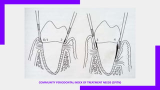 CPITN INDEX (Community Periodontal Index of Treatment Needs) | PPTX