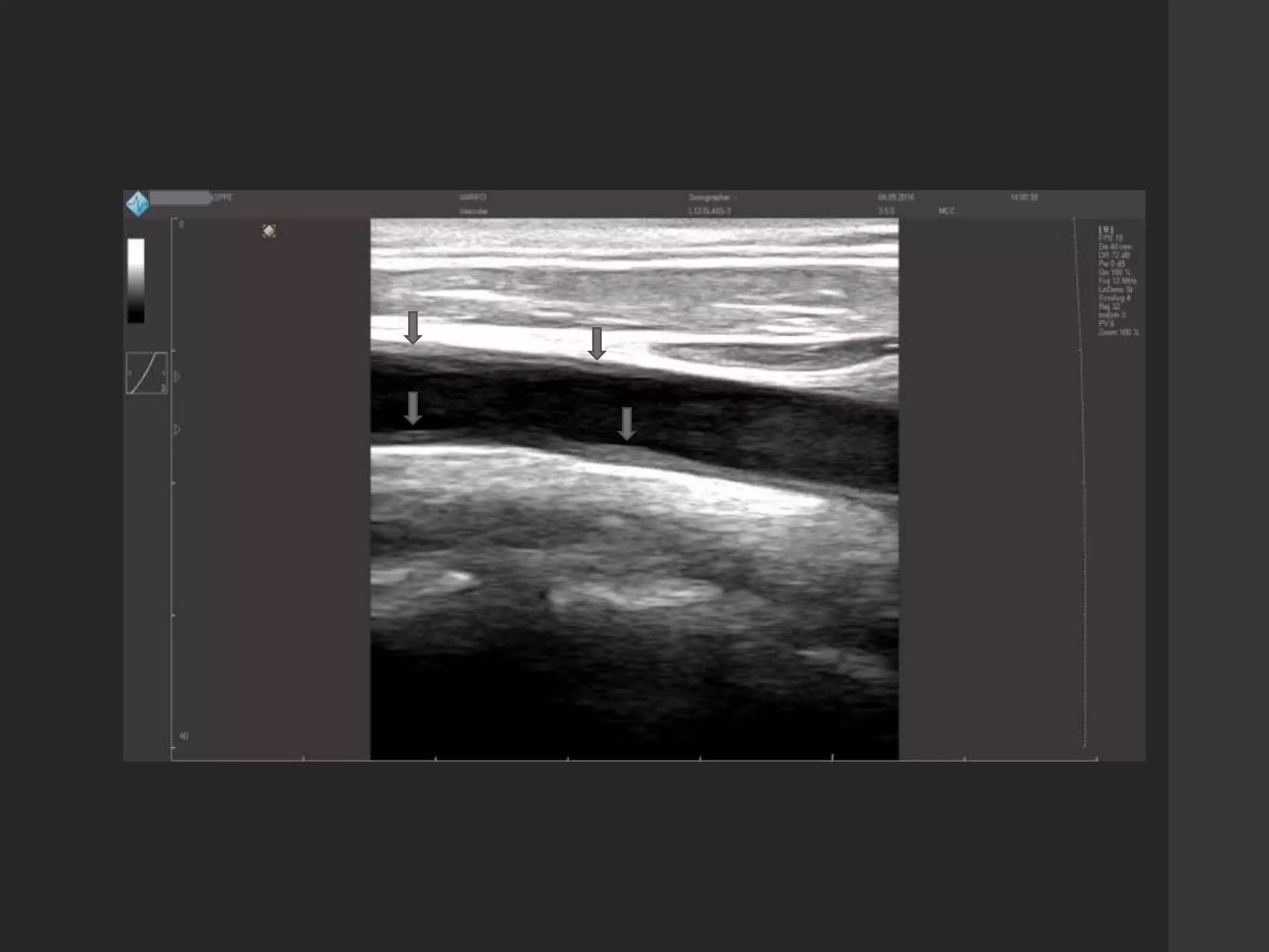 Carotid Plaque / Karotis Plaque | PPT