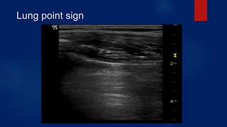 Catamenial Pneumothorax (mahesh) | PPT
