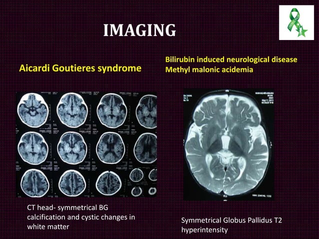 CP mimics.pptx | Brain and Nervous System Disorders | Diseases and ...
