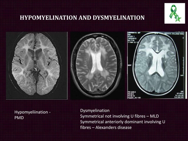 CP mimics.pptx | Brain and Nervous System Disorders | Diseases and ...