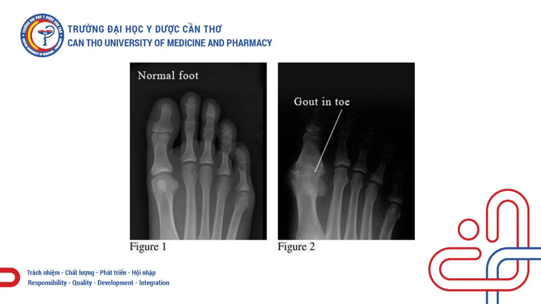 CẬP NHẬT GOUT NICE 2022.pptx