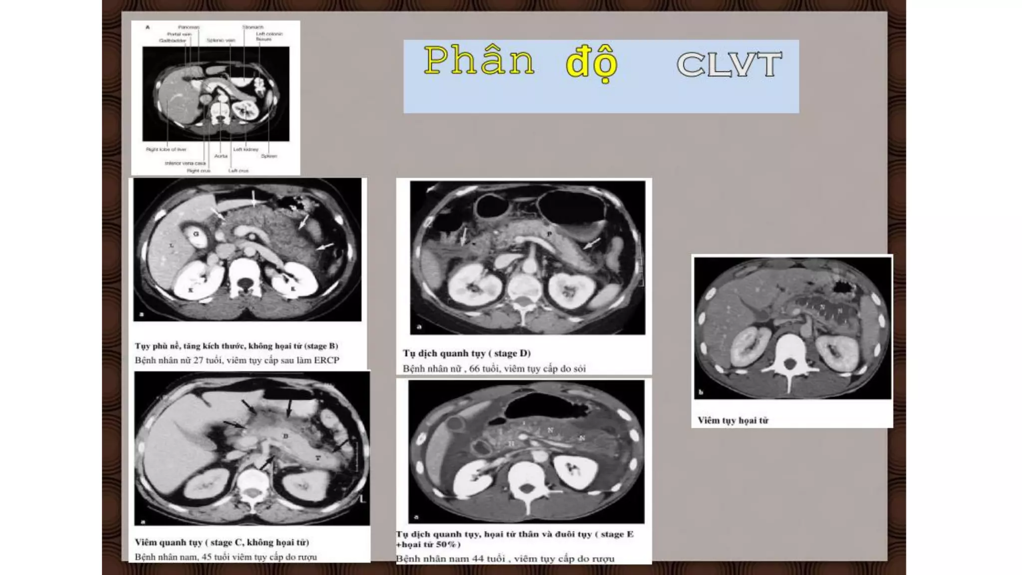 Cập nhật điều trị viêm tụy cấp 2023 - Bs Ck1 Đoàn Hoàng Long (1).pdf