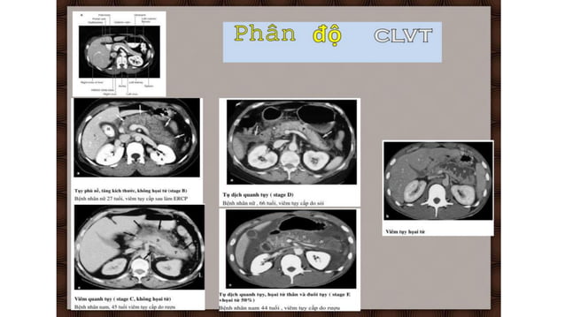 Cập nhật điều trị viêm tụy cấp 2023 - Bs Ck1 Đoàn Hoàng Long (1).pdf