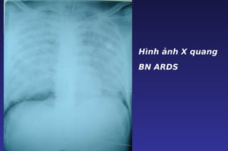 CẬP NHẬT VỀ HỘI CHỨNG SUY HÔ HẤP CẤP TIẾN TRIỂN (ARDS).pdf